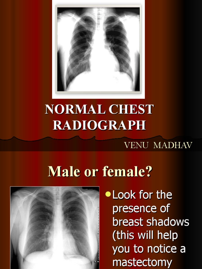 Normal Chest Radiograph | PDF | Lung | Radiography