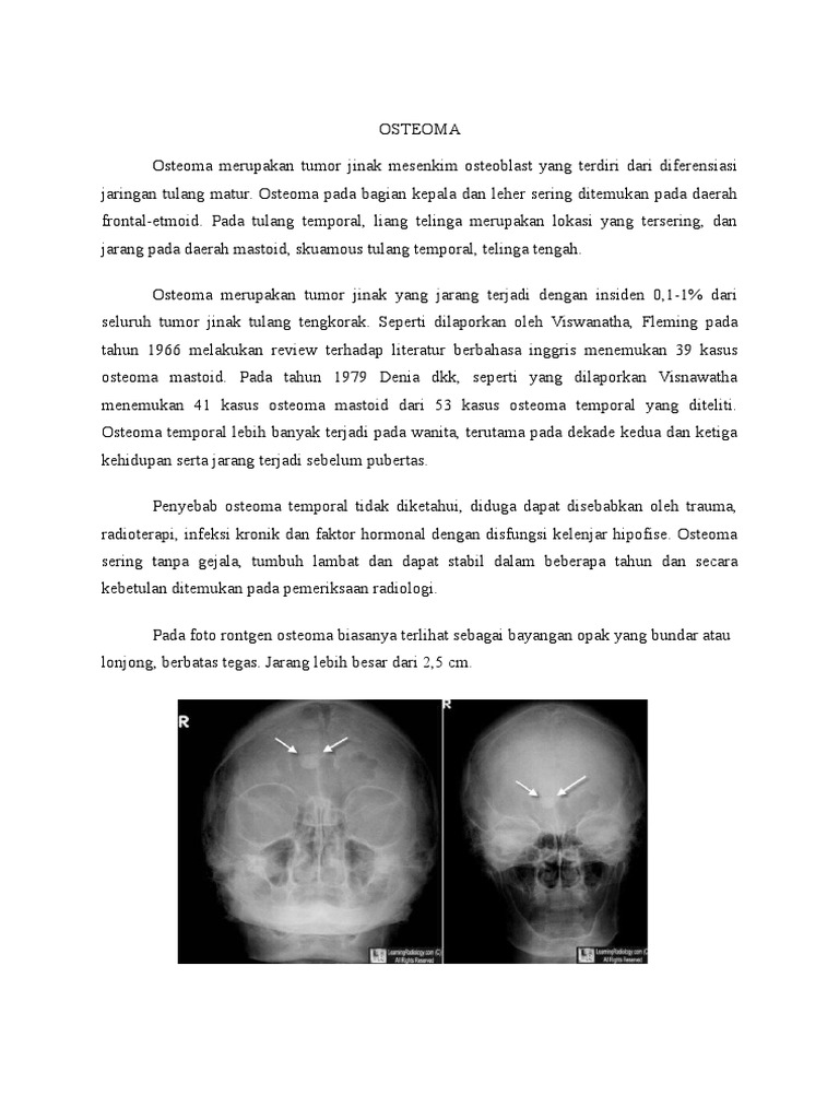 Osteoma | PDF