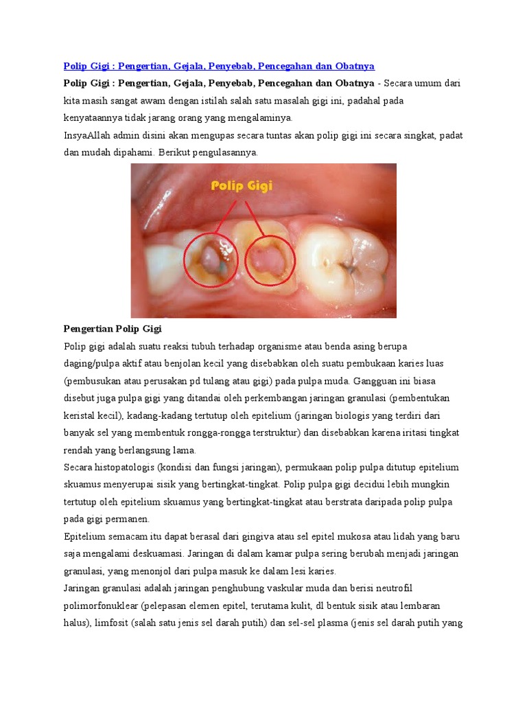 Polip Gigi | PDF