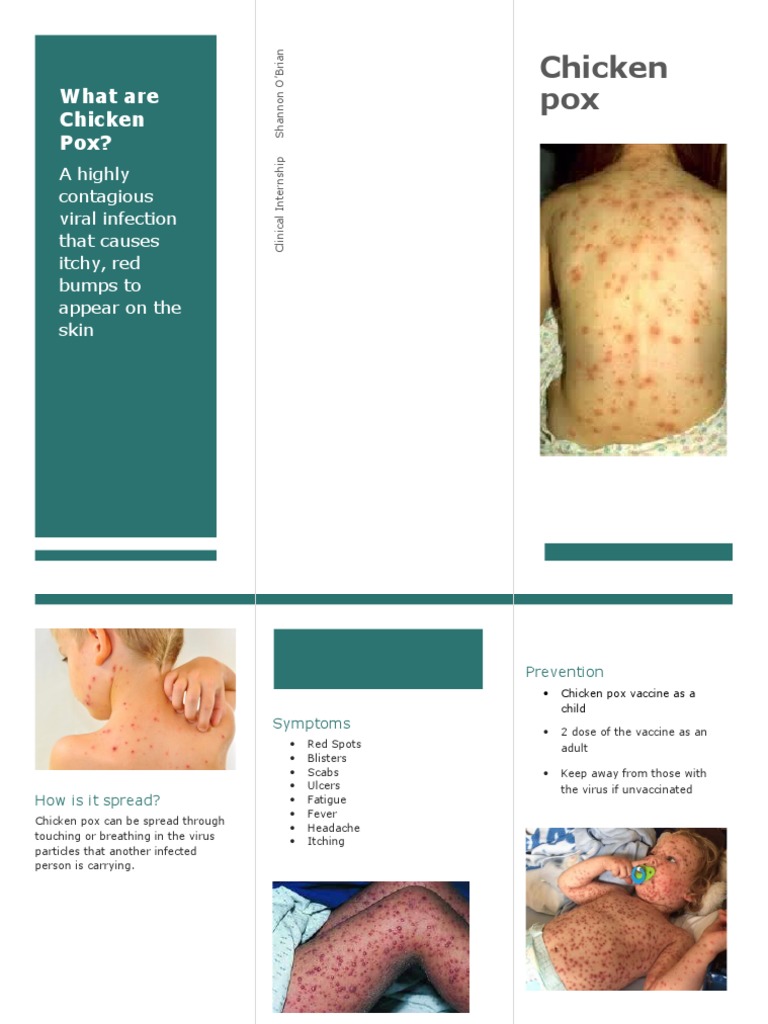 Chicken Pox | PDF