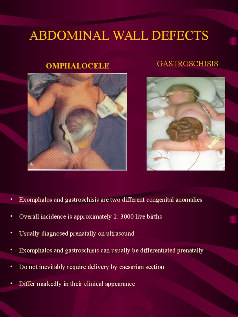 Omphalocele vs Gastroschisis Overview | PDF | Congenital Disorder ...