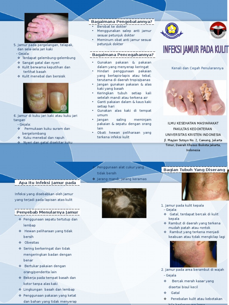 Infeksi Jamur Pada Kulit (Leaflet) | PDF