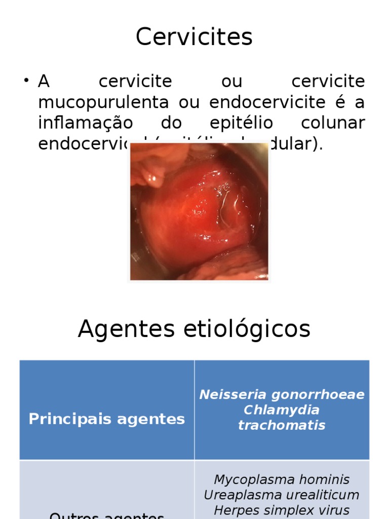cervicite.pptx-1 | Doenças do Sistema Geniturinário | Patologia Clínica