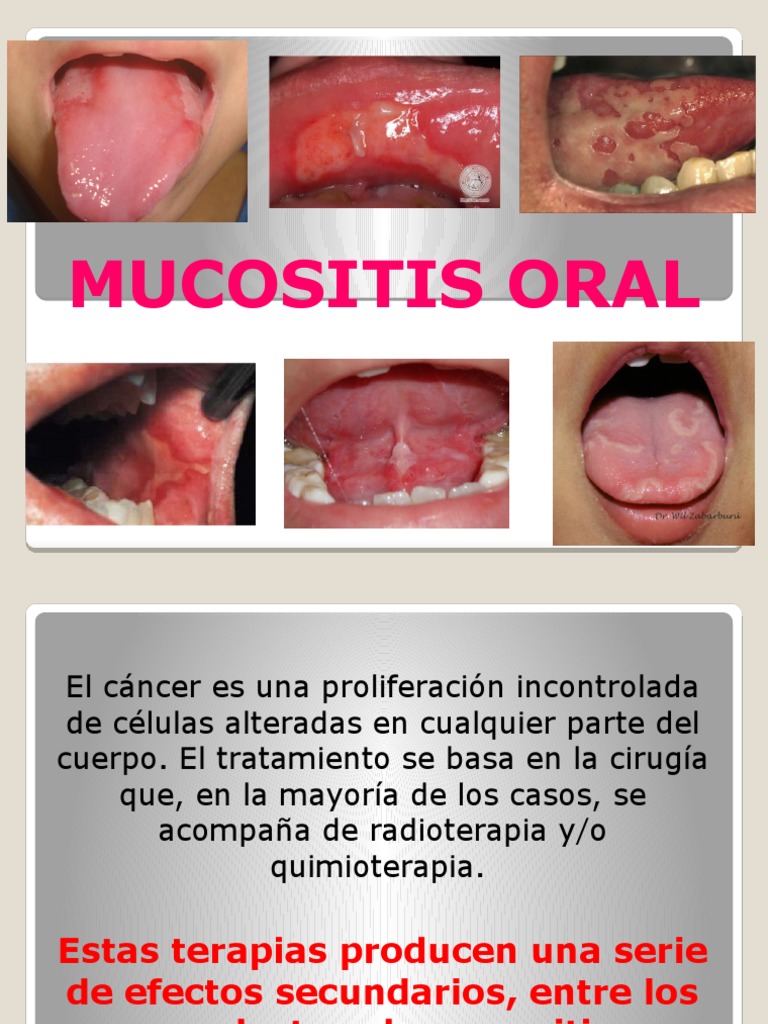 Mucositis