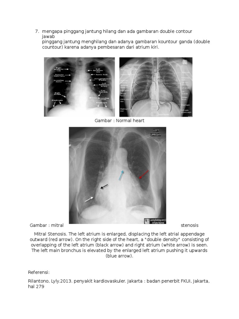 Enlarged Left Atrium Causing Disappearance of Heart Border and Double ...