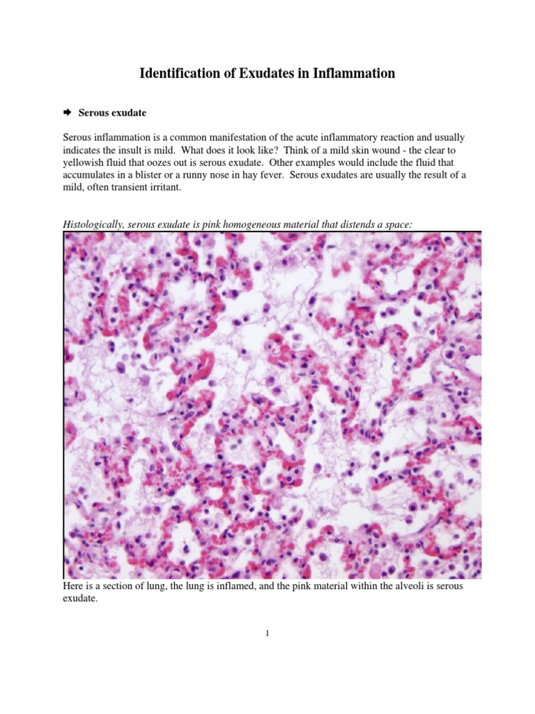 Identification of Exudates in Inflammation | Mucus | Inflammation