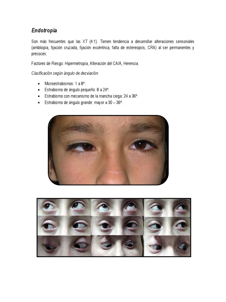 Estrabismo: Tipos y Tratamientos | PDF | Ojo humano | Percepción visual