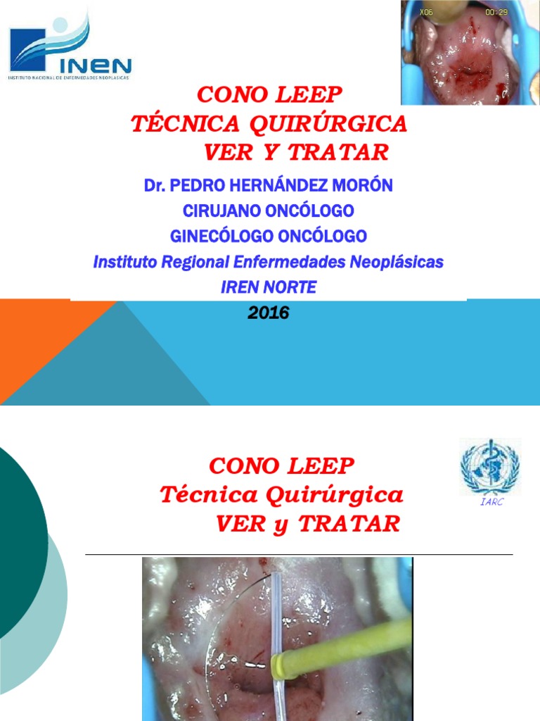 Cono LEEP Técnica Dr. HERNÁNDEZ Nov 2016.pdf | Cáncer de cuello uterino ...
