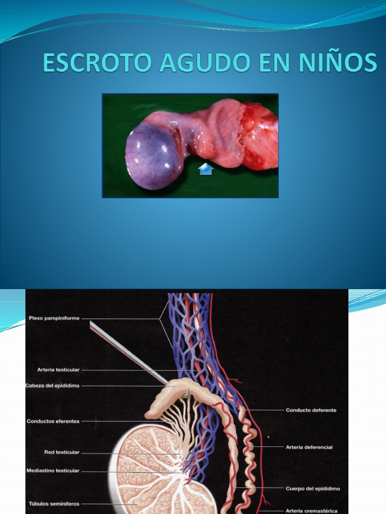 Escroto Agudo en Niños | Testículo | Especialidades Medicas