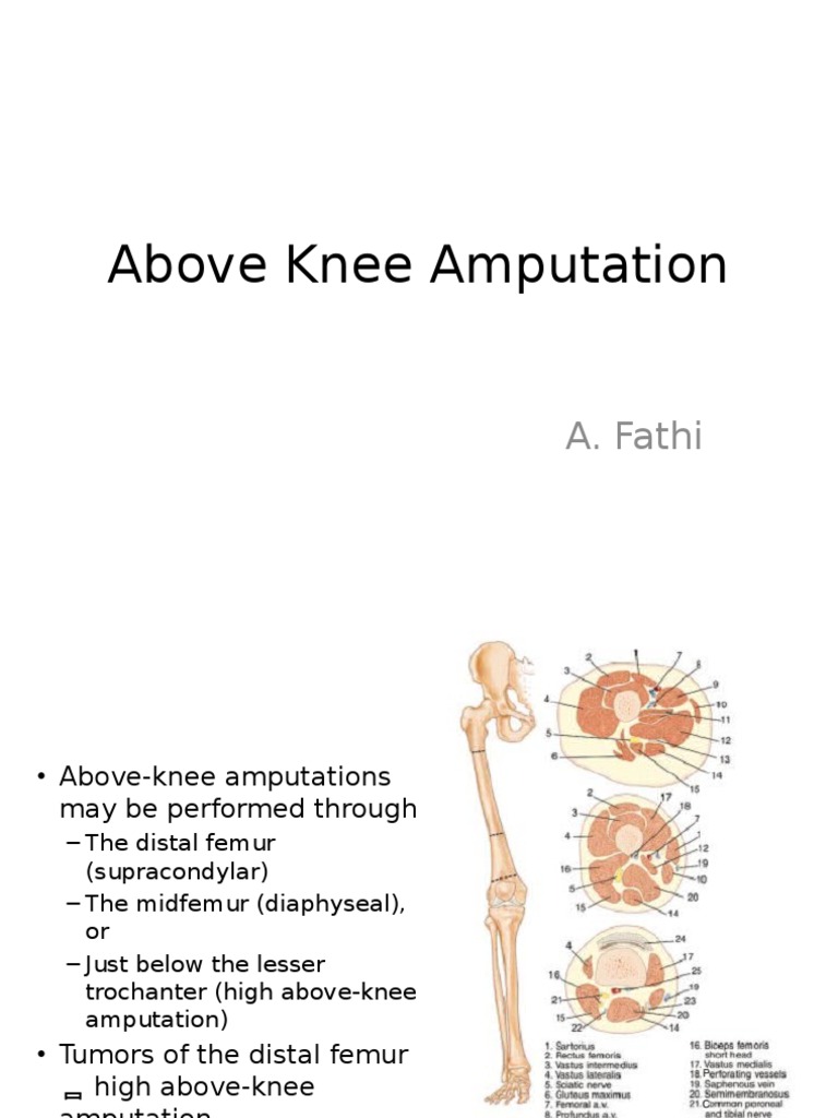 Above Knee Amputation Techniques | PDF