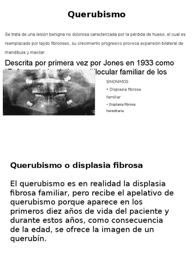 Querubismo: Displasia Fibrosa Familiar | PDF