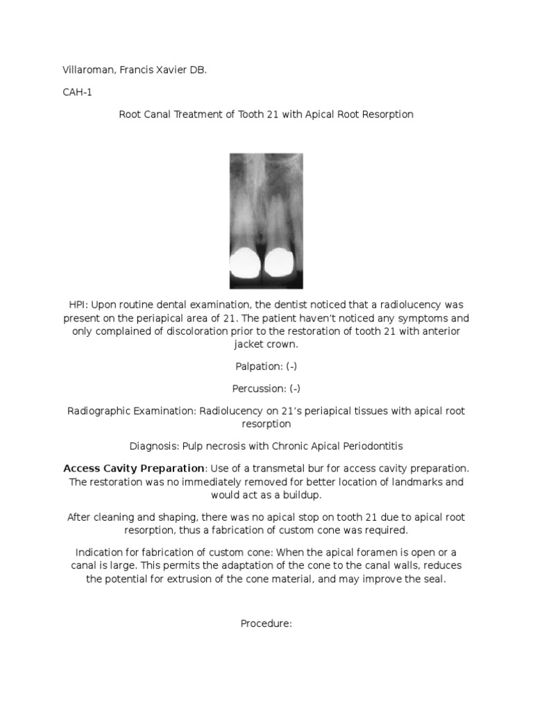 Access Cavity Preparation: Use of A Transmetal Bur For Access Cavity ...