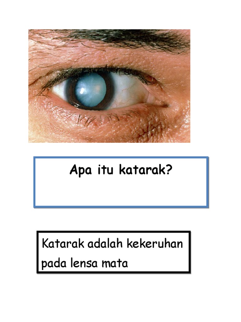 Poster Katarak | PDF