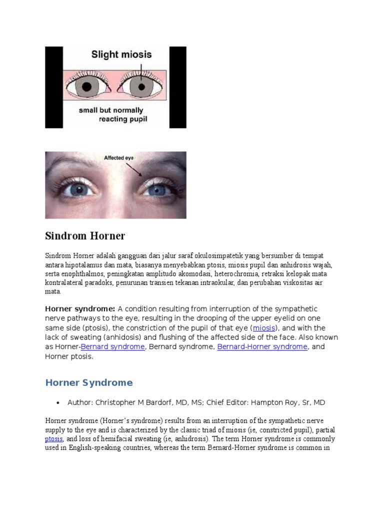 Sindrom Horner | PDF | Medicine | Diseases And Disorders