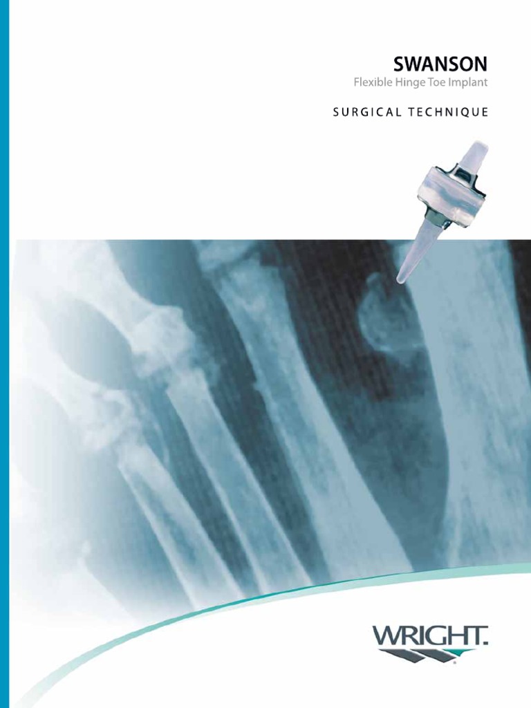 Swanson Toe Replacement | PDF | Toe | Foot