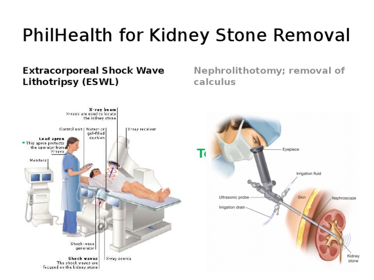 PhilHealth For Kidney Stone Removal | PDF