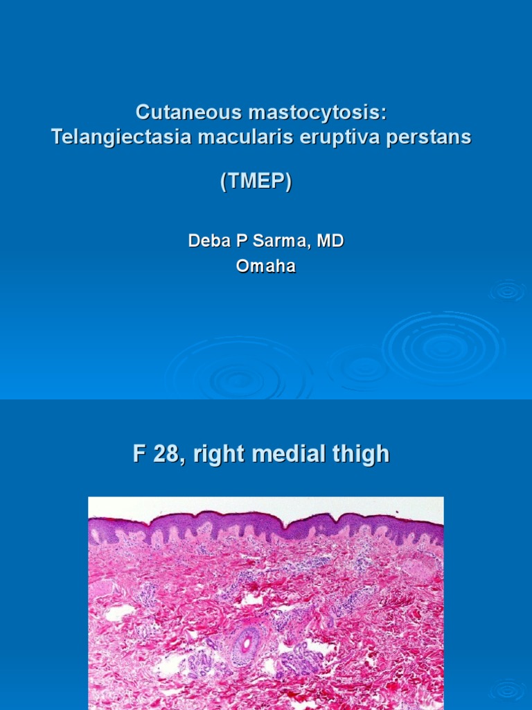Cutaneous Mastocytosis - Telangiectasia Macularis Eruptiva Perstans ...