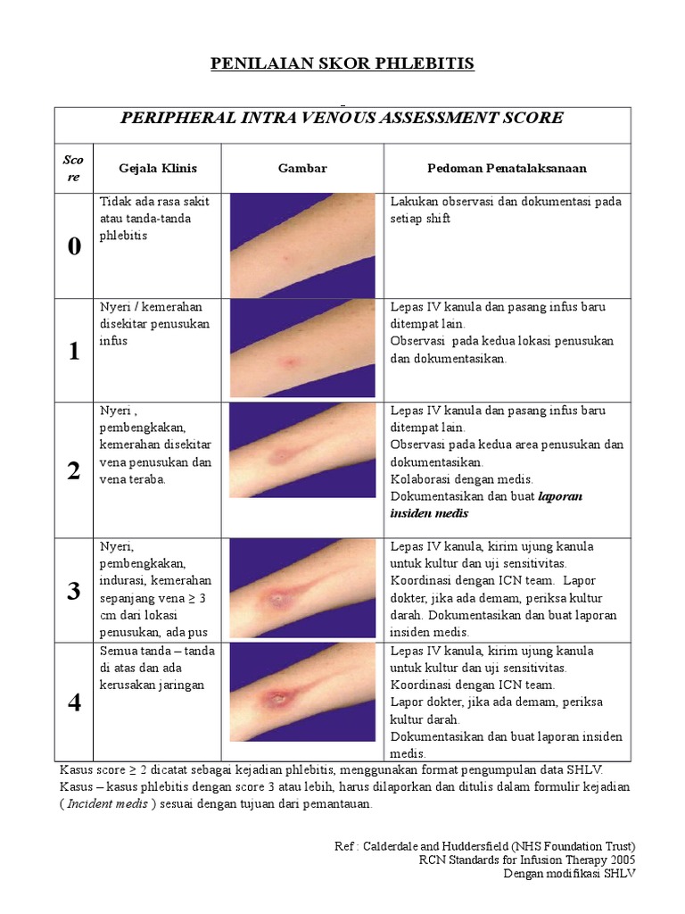 Phlebitis Guidlines | PDF