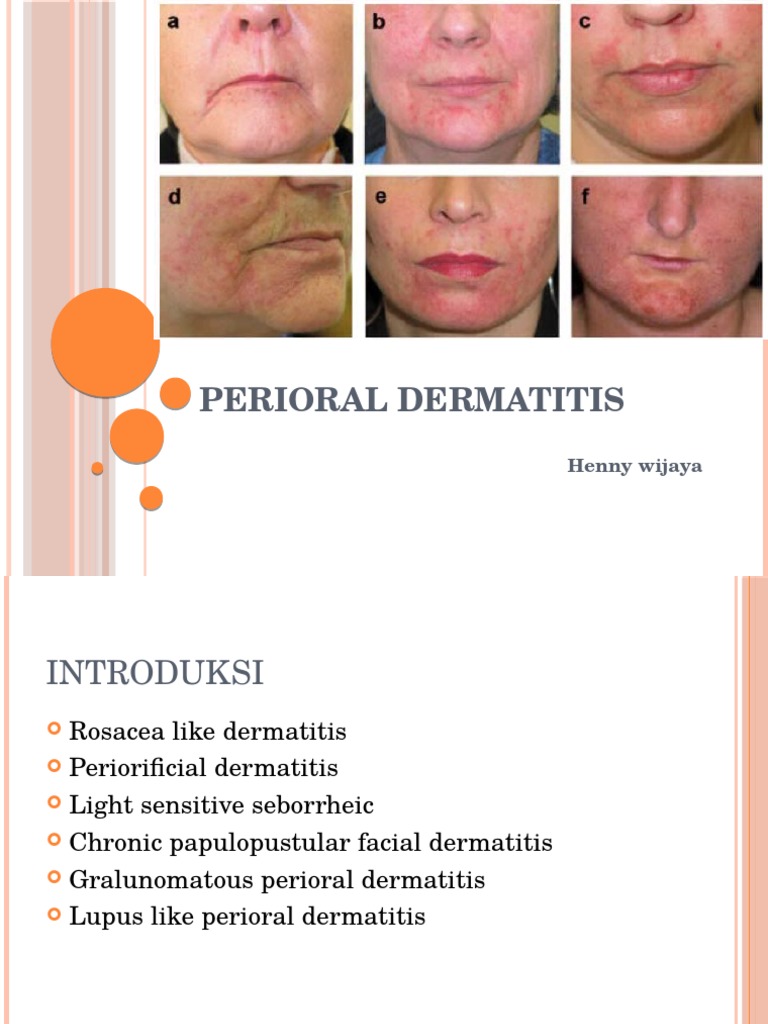 Perioral Dermatitis | PDF