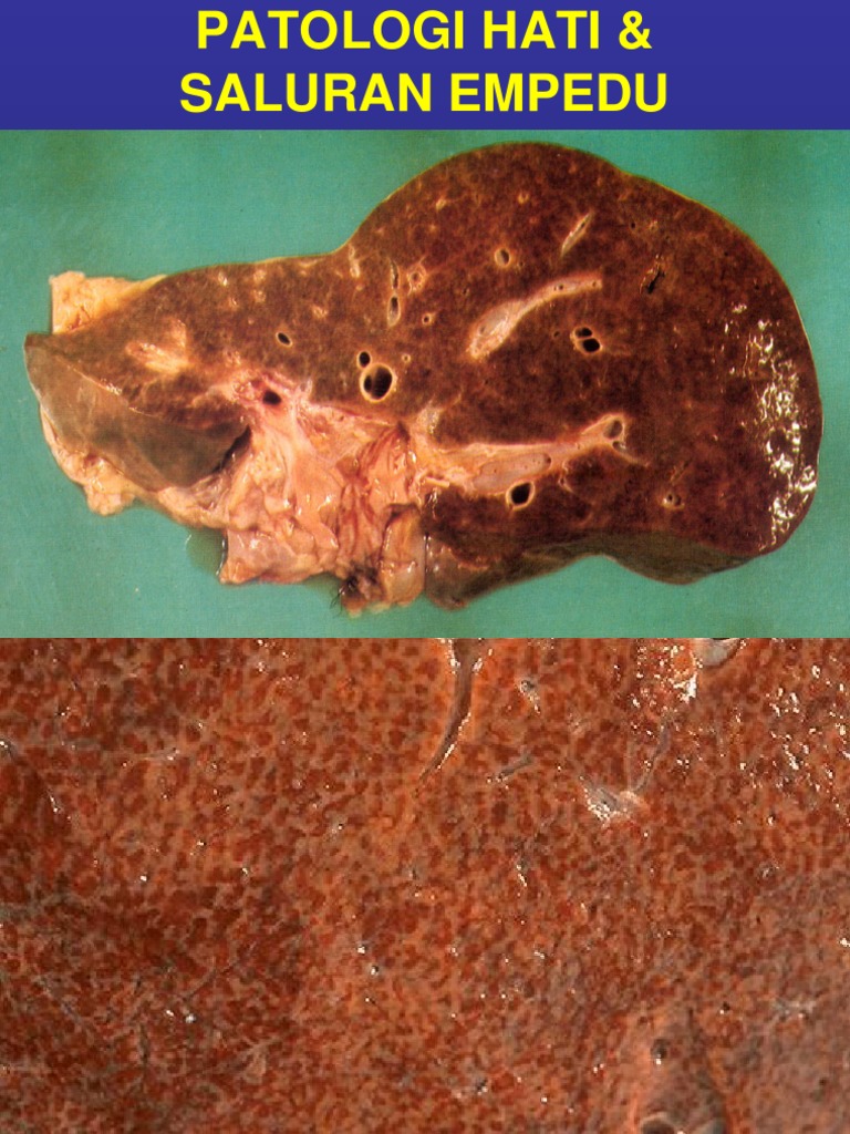Patologi Hepar | PDF