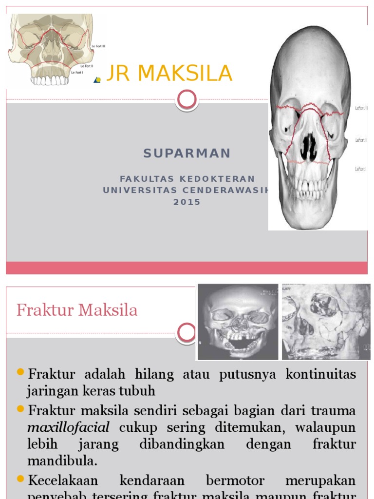 Fraktur Maksila | PDF