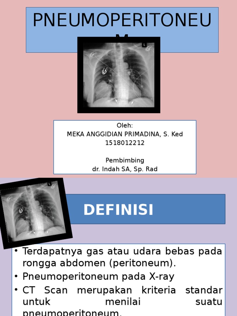 Pneumo Peritoneum | PDF
