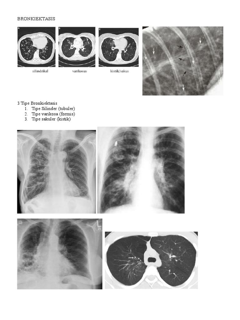 Gambar Radiologi Abses Paru | PDF