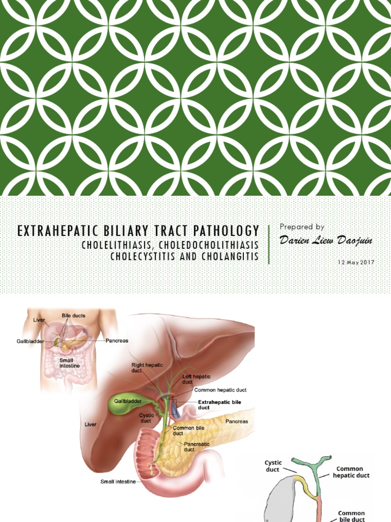 Extrahepatic Biliary Tract Pathology - Cholidolithiasis ...