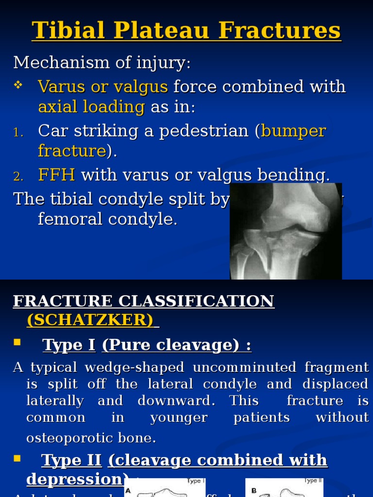 Tibial Plateau Fracture Classification and Management | PDF | Injury ...