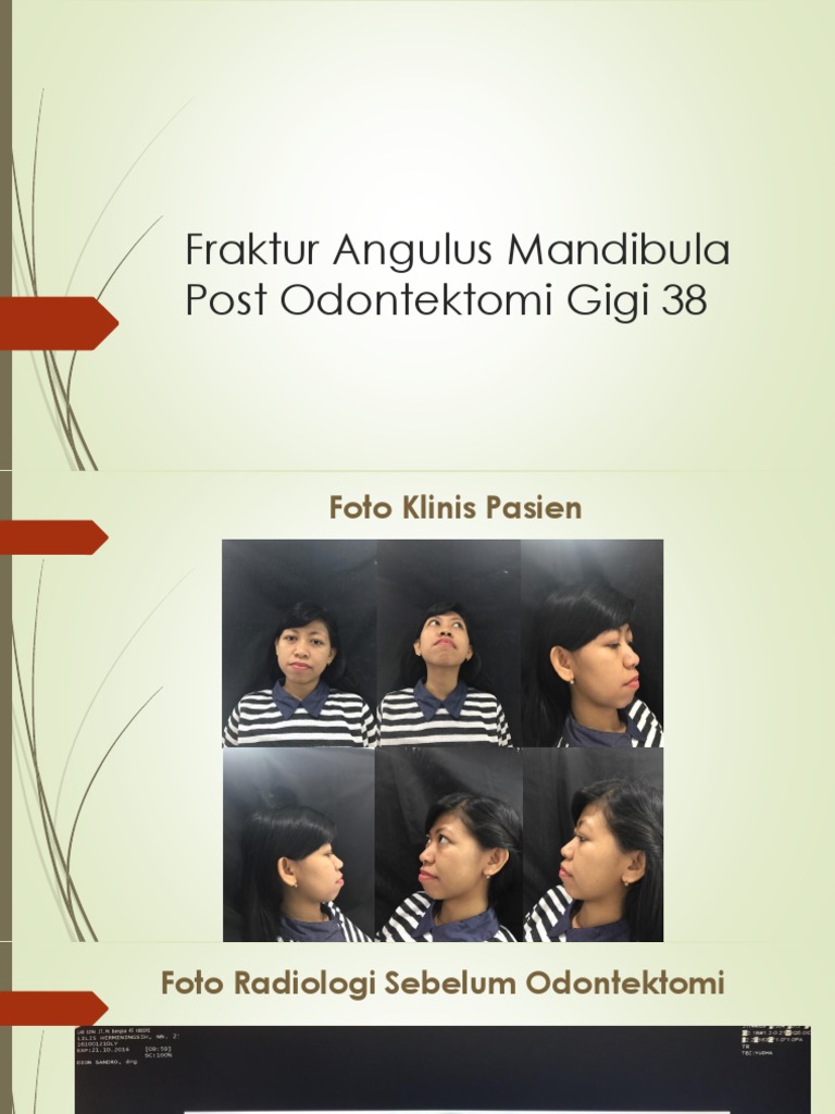 Fraktur Angulus Mandibula Post Odontektomi Gigi 38 PDF | PDF