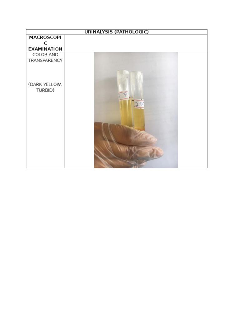 Color and Transparency: Urinalysis (Pathologic) Macroscopi C ...
