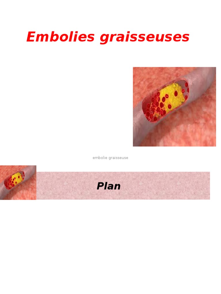 Embolie Graisseuse Def _ Embolie Graisseuse Fond D’Oeil – FYNSR