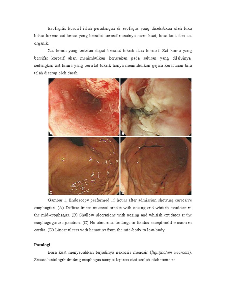 Esofagitis Korosif | PDF | Kajian Bahasa Asing | Kesehatan Holistik