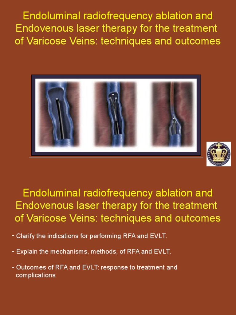 EVLT and RFA for Varicose Veins: Techniques, Outcomes & Complications ...