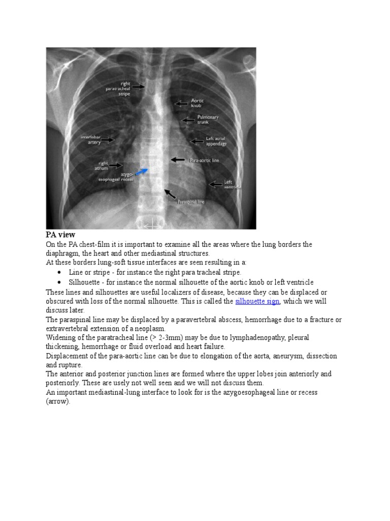 Chest X-Ray Interpretation Guide | PDF