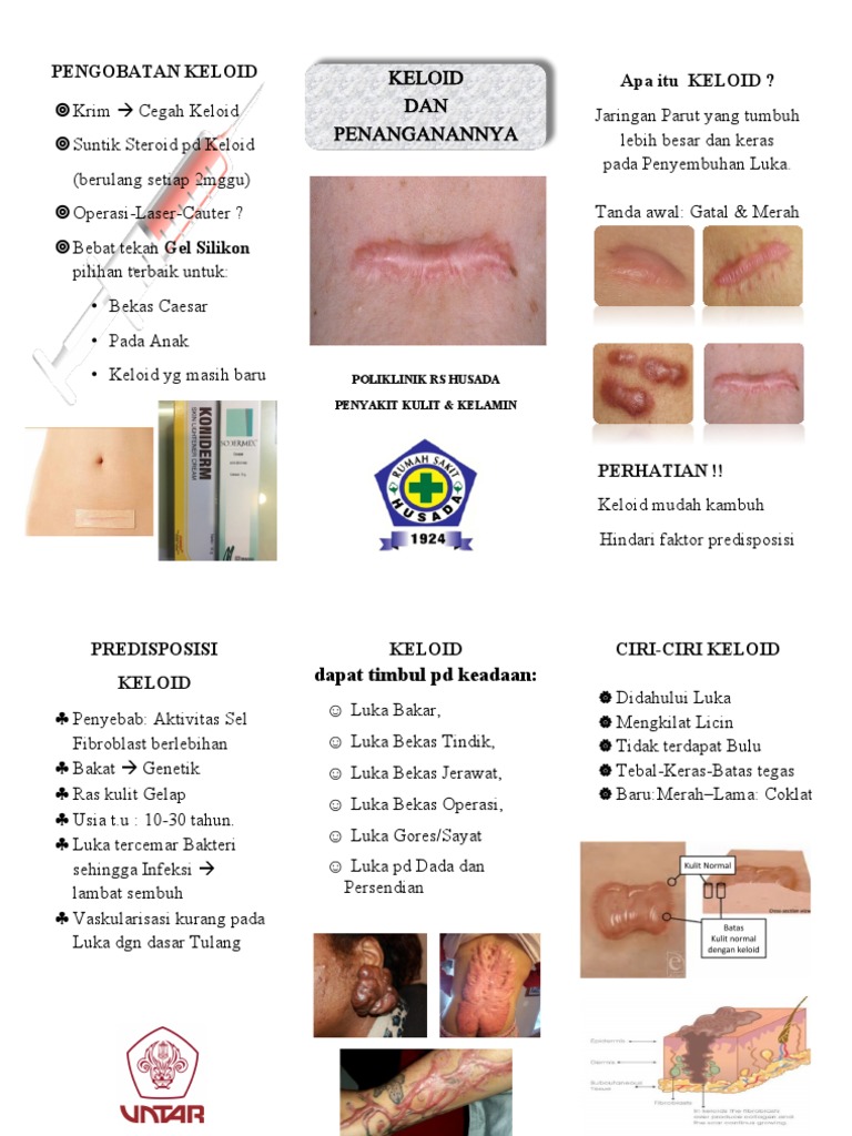 Leaflet Keloid (Kulit Untar) | PDF