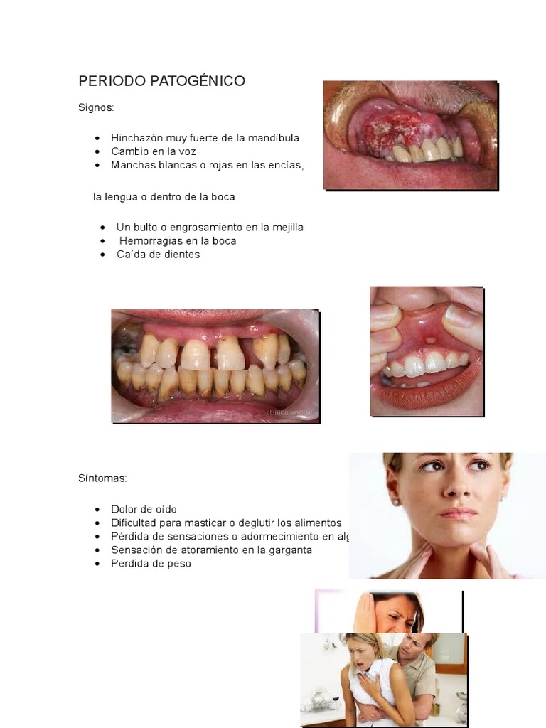 Periodo Patogénico Cancer Oral | PDF