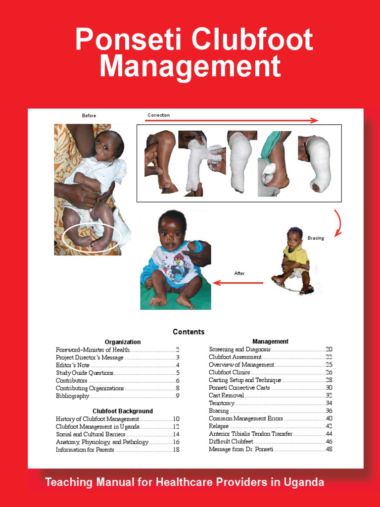 Ponseti Method for Clubfoot Management | PDF | Health Care | Orthopedic ...
