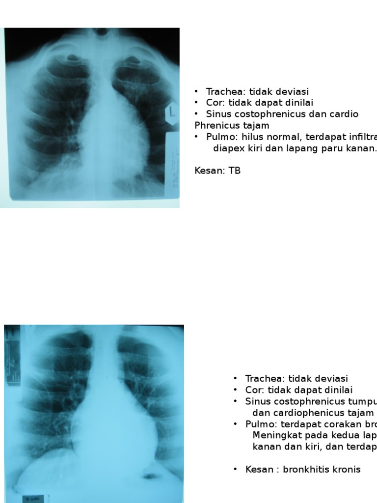 Sinus Costophrenicus dalam Radiologi | PDF