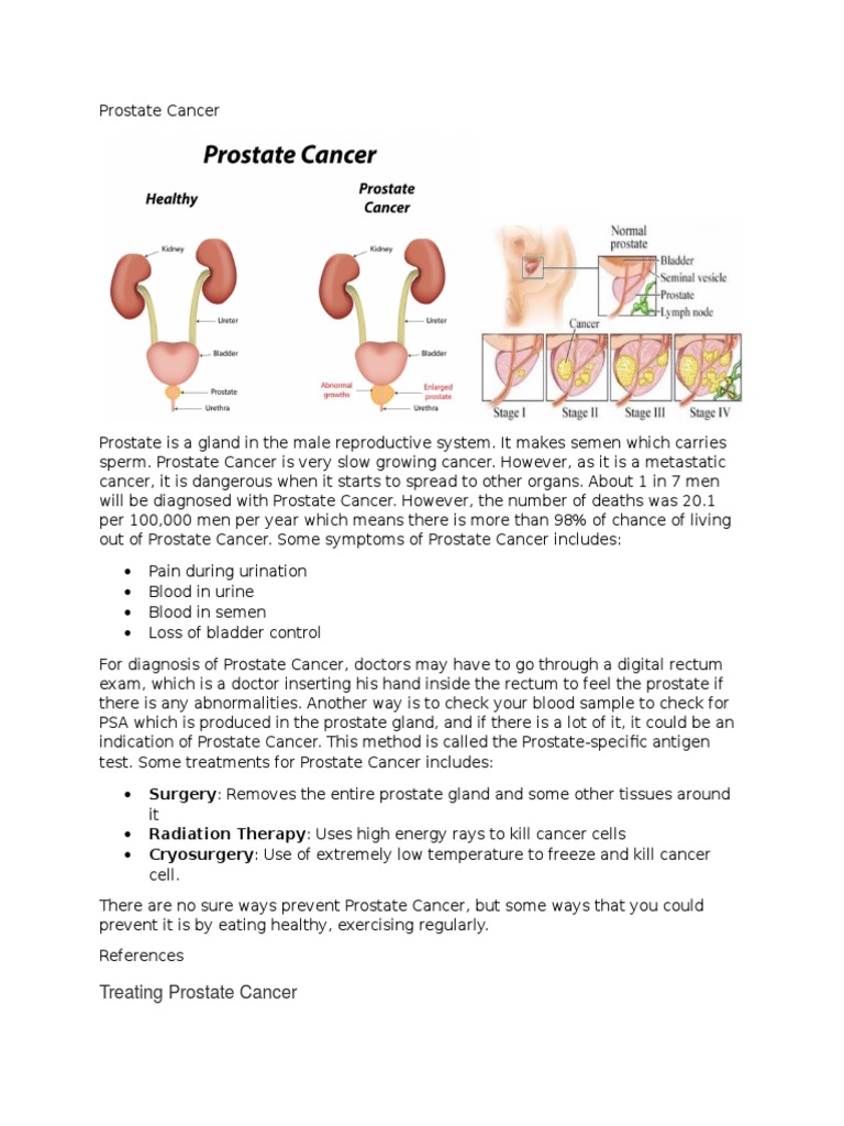 Prostate Cancer | PDF