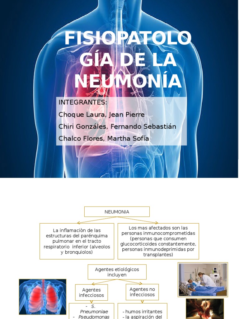 Neumonías Bacterianas Agudas Típicas | Neumonía | Tos