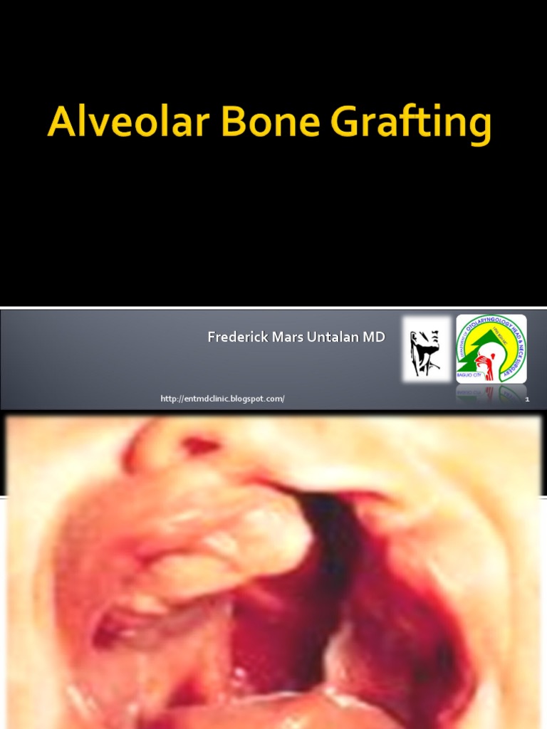 Alveolar Bone Grafting. | PDF | Medical Specialties | Clinical Medicine