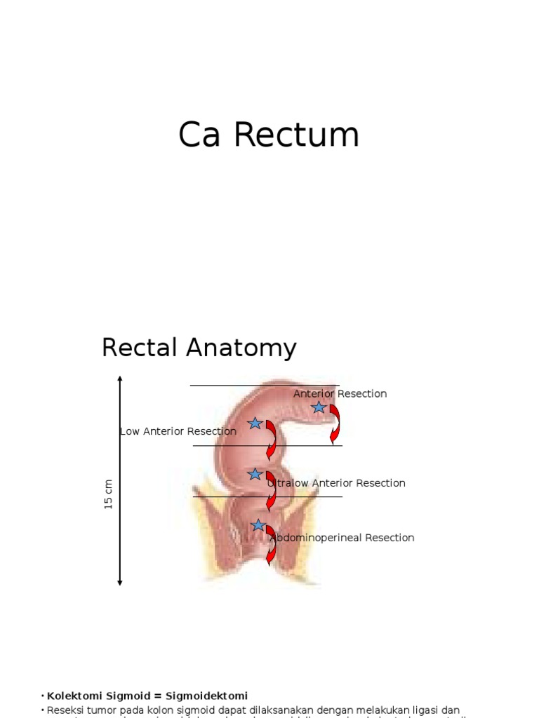 Ca Rectum | PDF | Kantung Empedu | Perut