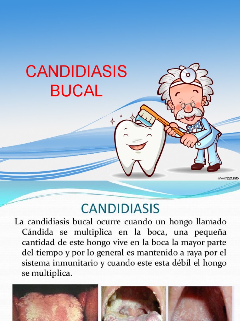 Candidiasis Bucal en Bebés y Adultos | PDF | Candidiasis | Infección