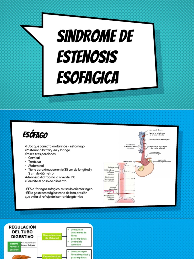 estenosis esofagica | Especialidades Medicas | Enfermedades y trastornos