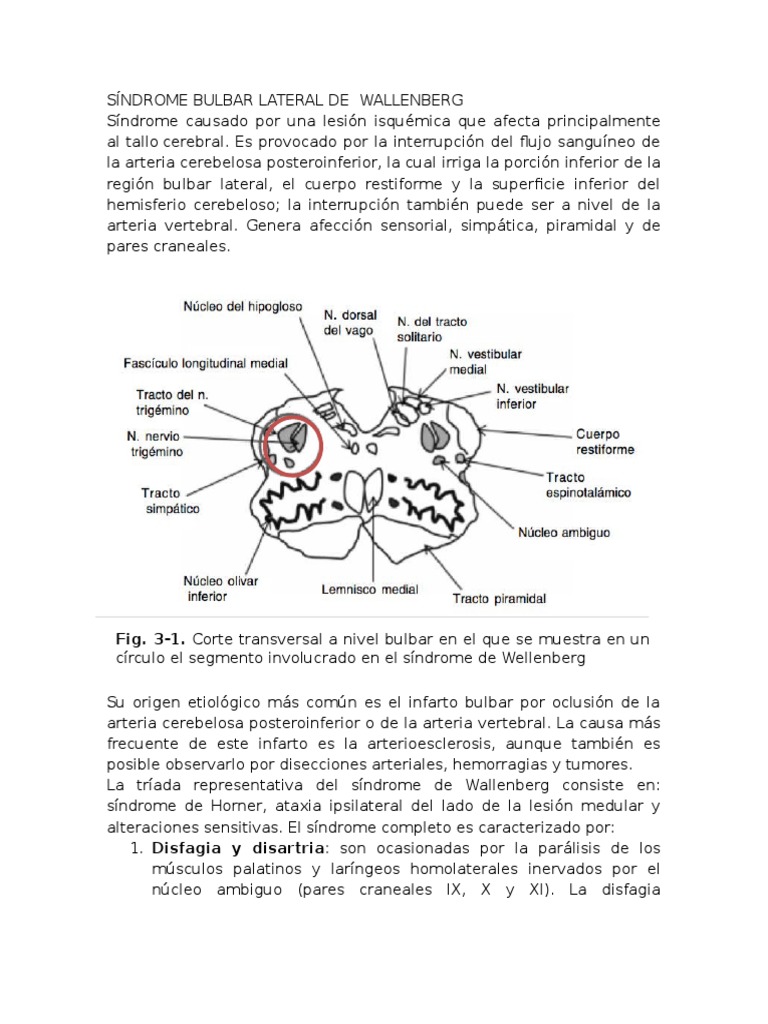 SÍNDROME BULBAR LATERAL DE WALLENBERG | Infarto agudo de miocardio ...