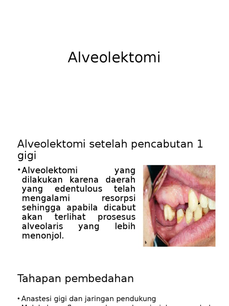 Alveolektomi | PDF