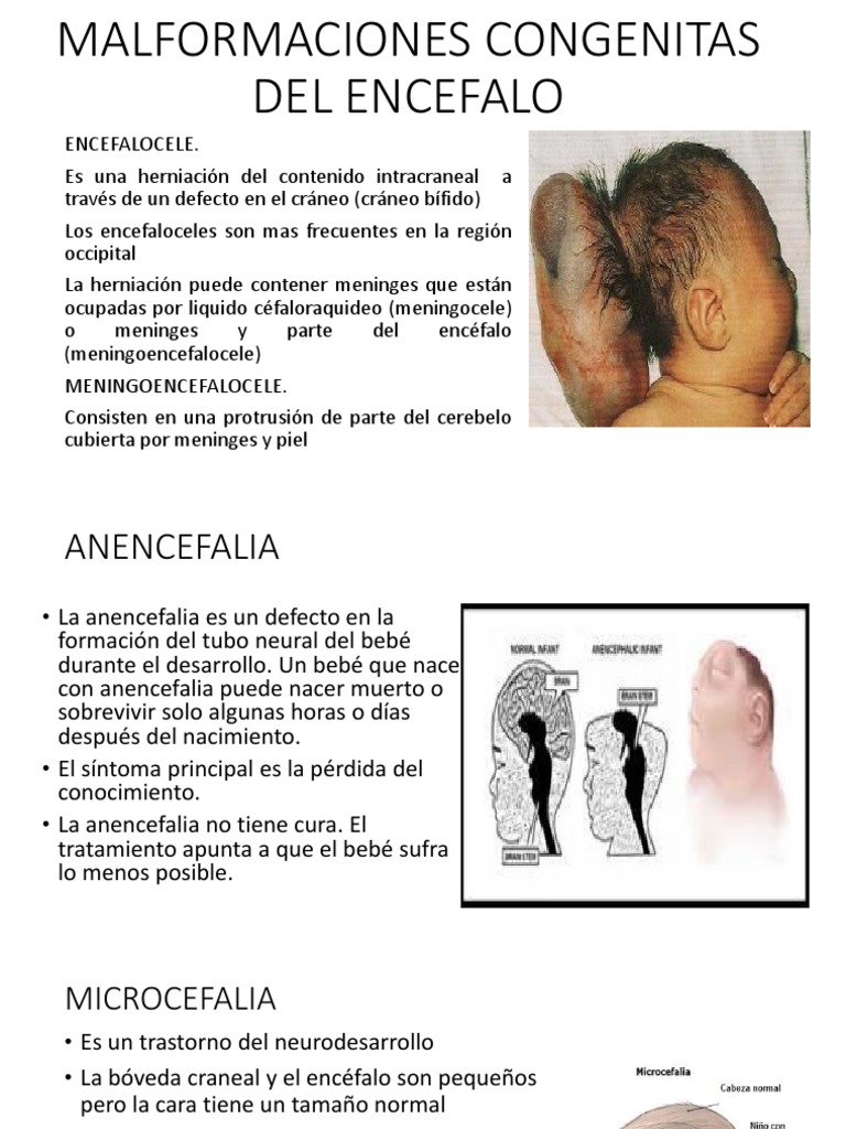 Malformaciones Congenitas Del Encefalo | PDF