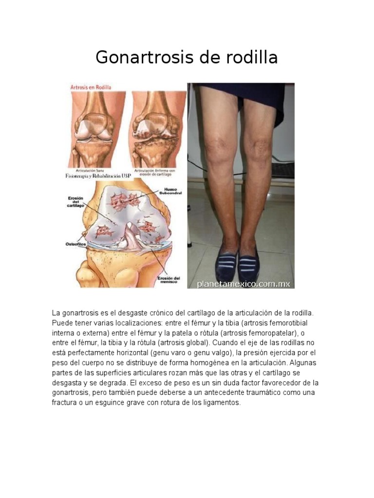 Gonartrosis de Rodilla | PDF