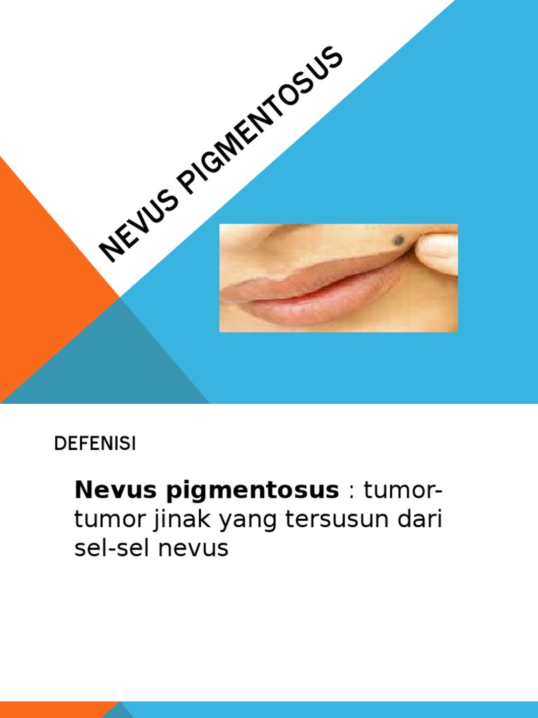Nevus Pigmentosus